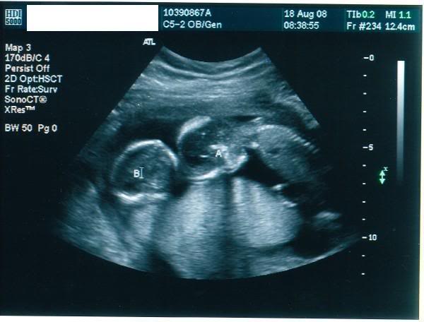 wth hidden twin??? - Page 4 - BabyCenter