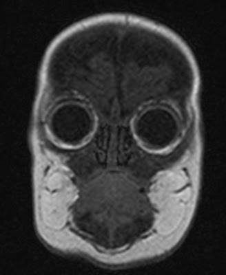 Neonatal MRI Faces