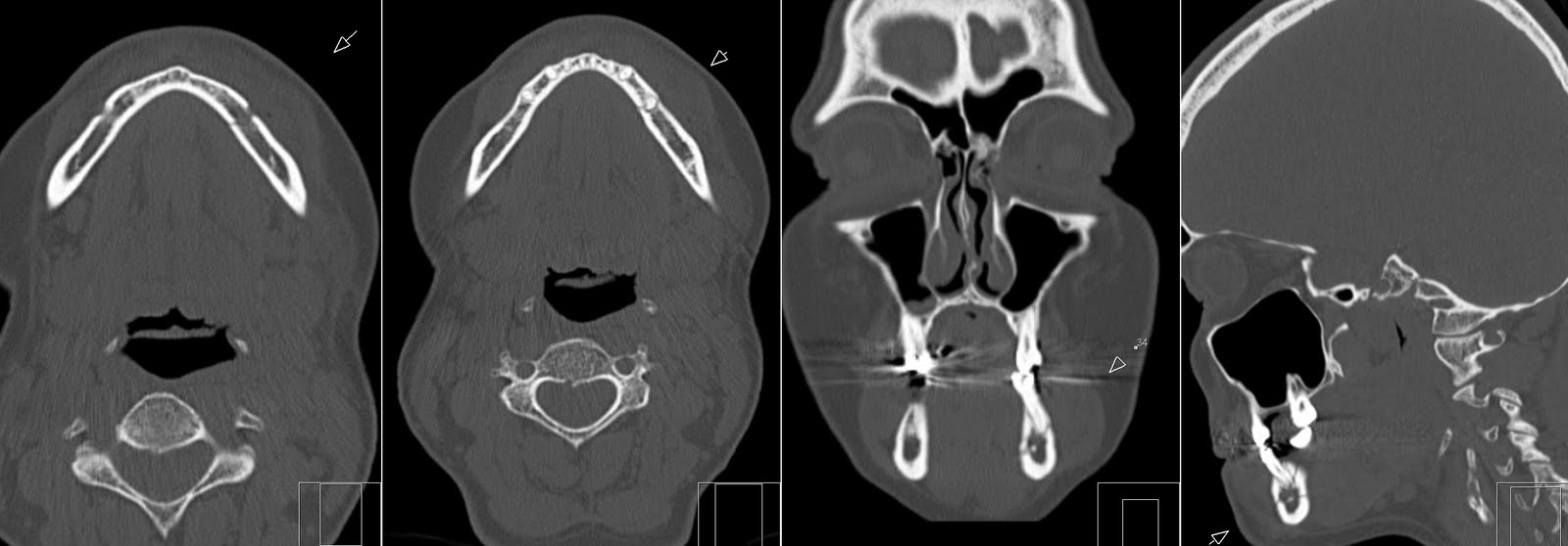 Mandibula Fracture