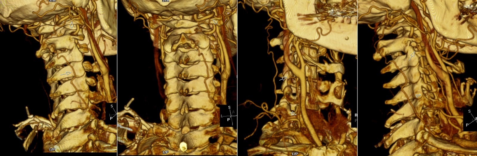 Vertebral Artery Dissection Collaterals