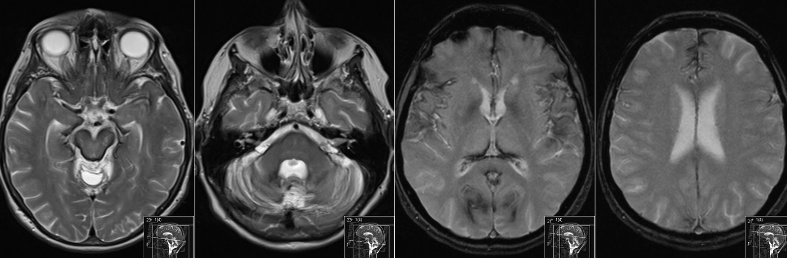 Radiology MRI: Superficial Siderosis