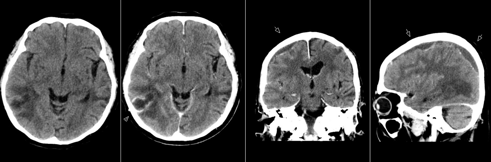 Abscess and Subdural Empyema