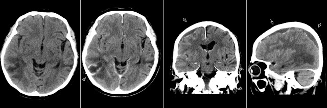 Abscess and Subdural Empyema - Radiology Imaging