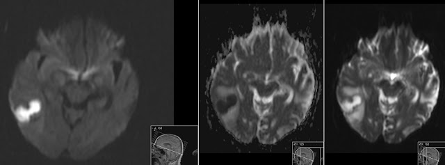 Abscess and Subdural Empyema - Radiology Imaging