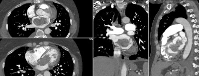 Myxoma - Radiology Imaging