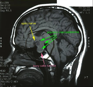 CT/MRI: Pituitary Macroadenoma
