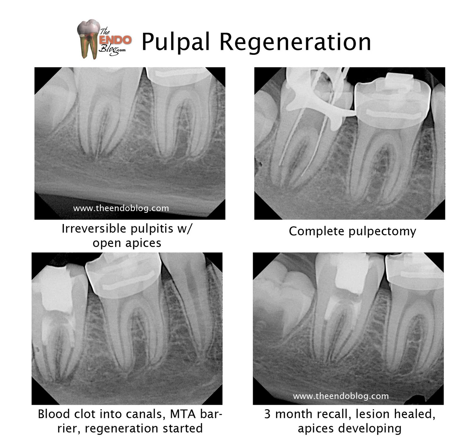 Pulpitis on X Ray - TheDentech.com