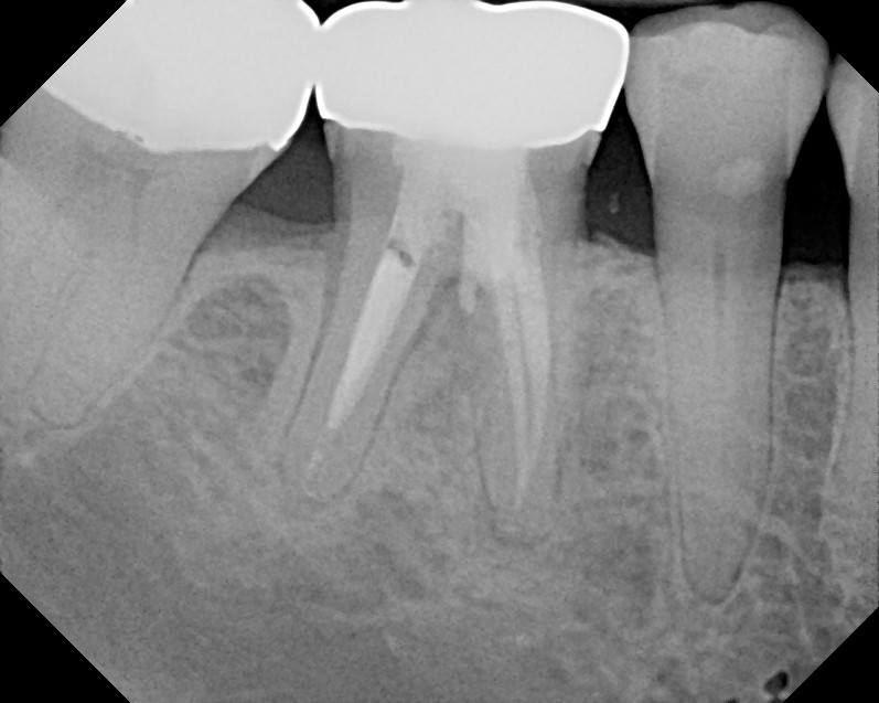 Perforation Repair Endodontics at Kevin House blog