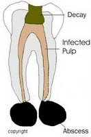 Causes of Tooth Abscess