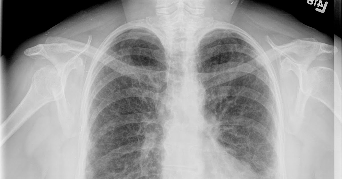 Pulmonary Roundtable: Worsening dyspnea in a patient with IPF