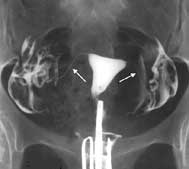 Our Little Family's Journey: HSG results