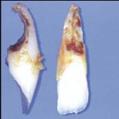 Aula Virtual Ortodoncia 3: Reabsorcion Radicular