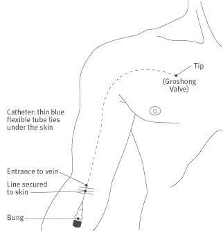My Fight Against Lyme Disease: PICC Line