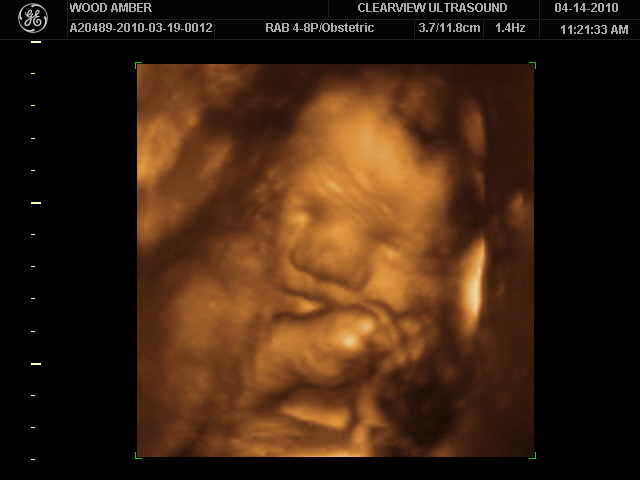 The Wood Family: 3D Ultrasound at 33 weeks