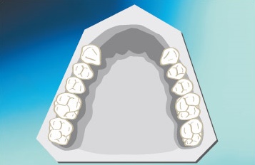 P D L: Partially Edentulous Conditions