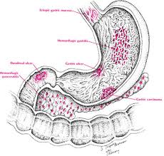 ESTUDANDO PATOLOGIA: Hemorragias Digestivas