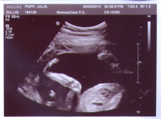 Our baby step by step!!: 20 Week Scan