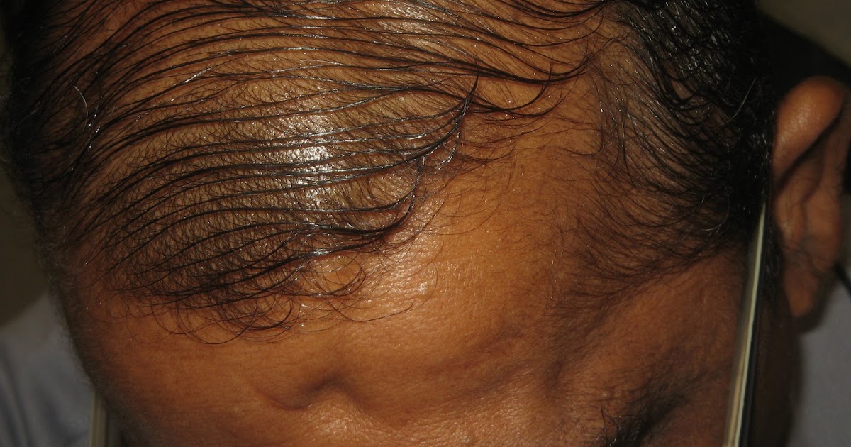 cushing-s-cancer-bitemporal-hemianopia
