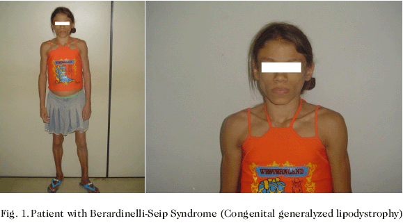 Endócrino News: Lipodistrofias