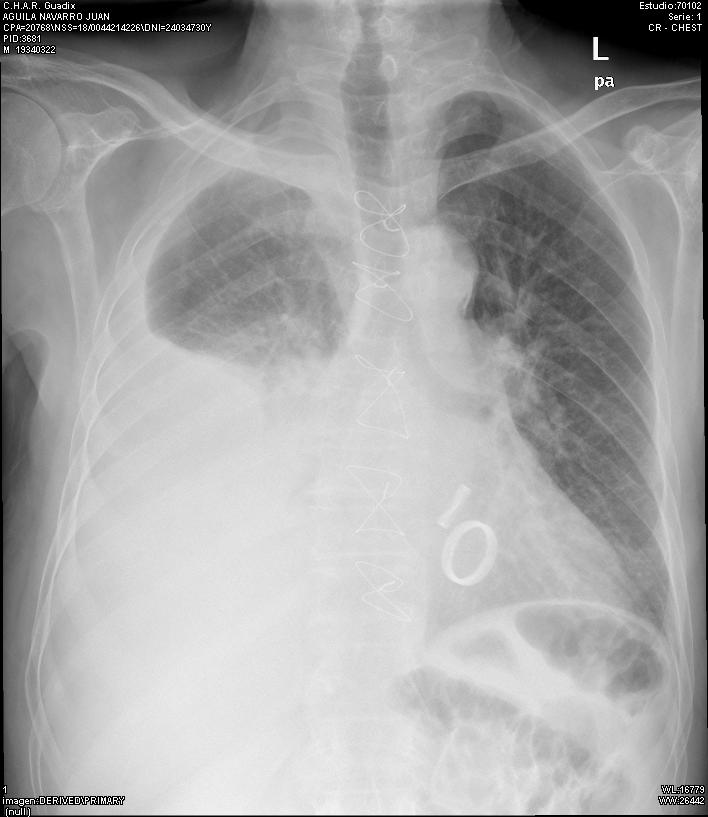 CASOS CLÍNICOS: Derrame pleural..facil...