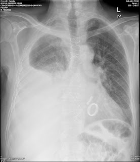 CASOS CLÍNICOS: Derrame pleural..facil...