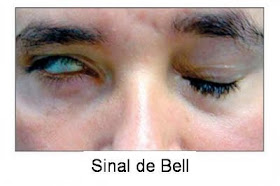 NONA ENFERMARIA: CLÍNICA MÉDICA: Paralisia Facial