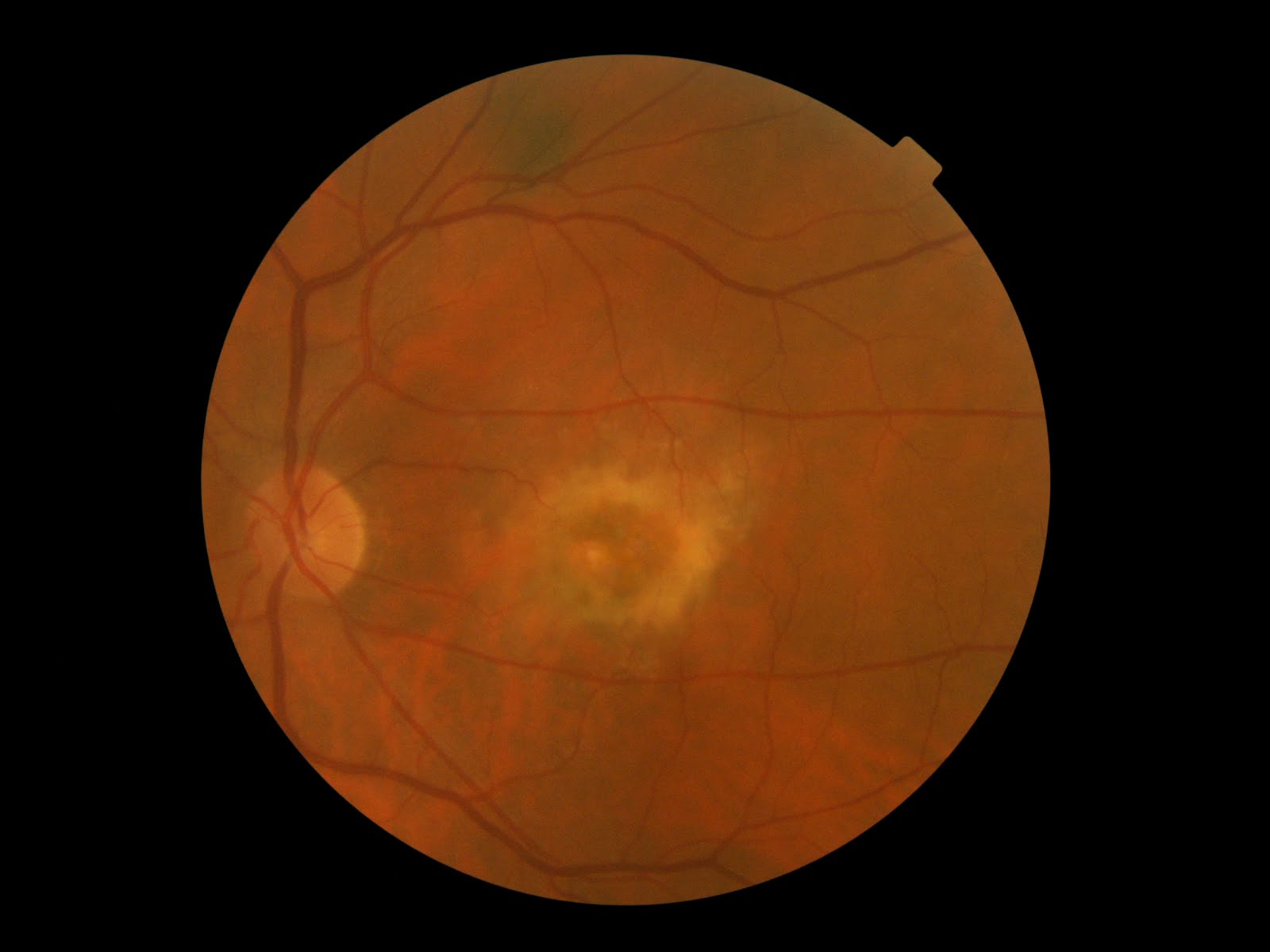 TOMOGRAFÍA DE COHERENCIA ÓPTICA: DMAE Húmeda