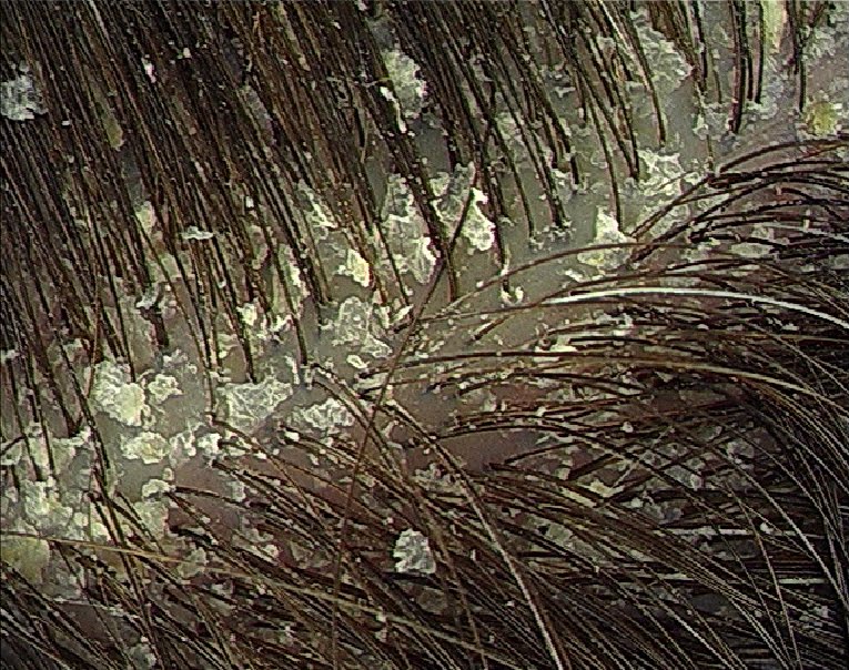 KulturaPinoy: Solusyon sa Dandruff o Balakubak