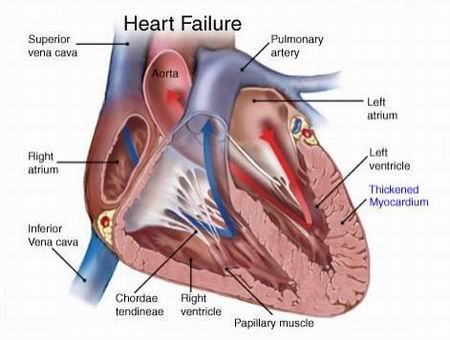 Medicine for health care: Congenital heart defects