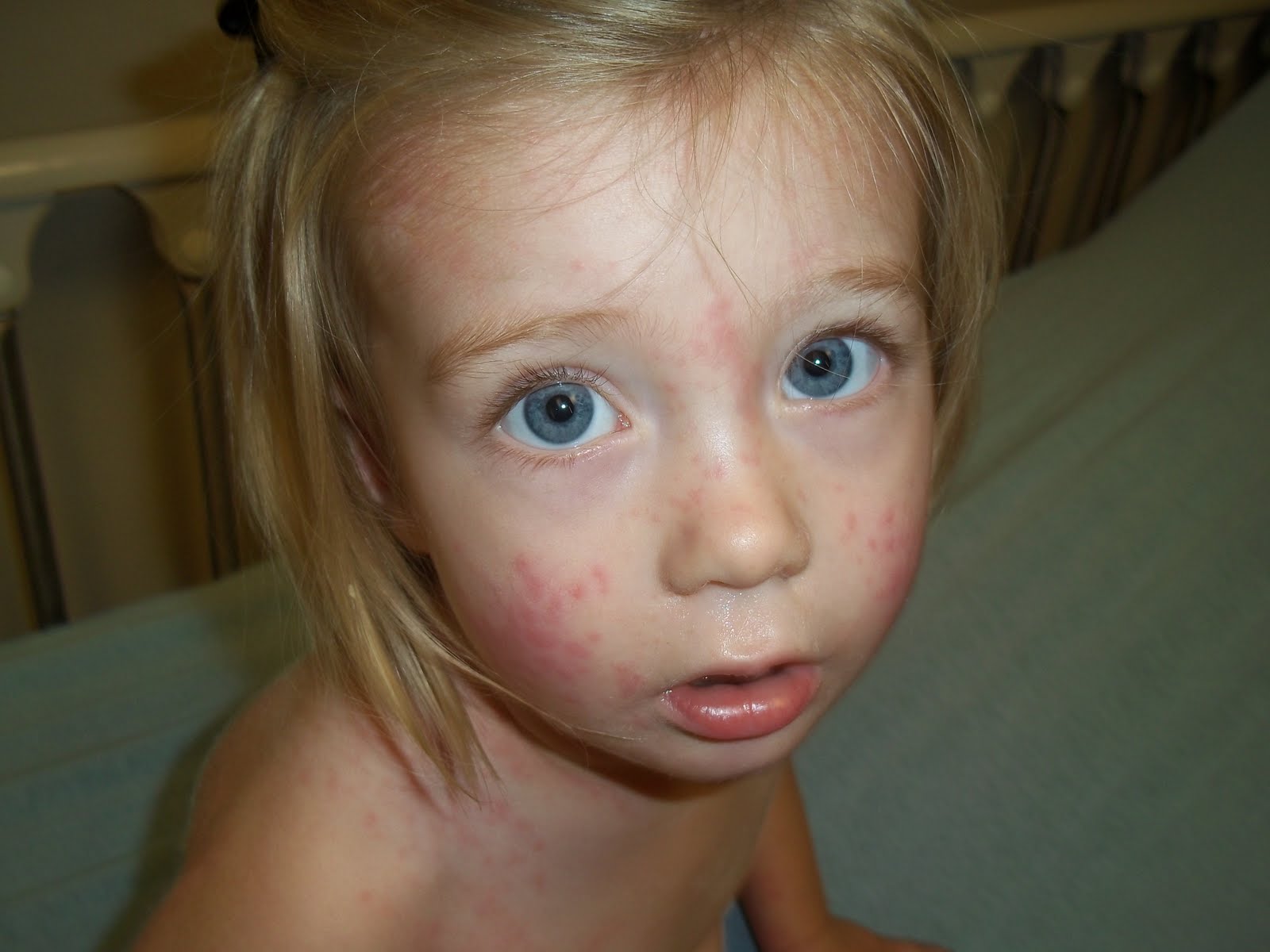Child Cold With Rash On Face At Samuel Massey Blog