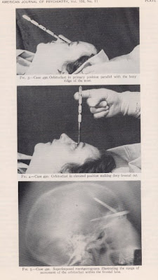 The Lobotomy Procedure