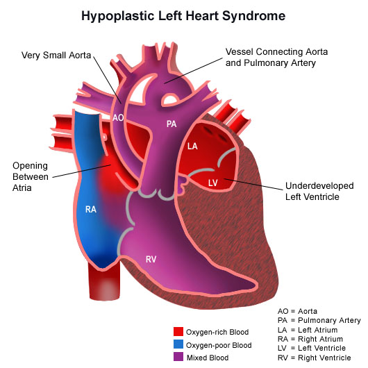 Michael Maverick Harris: Tricuspid Atresia vs Normal Heart and HLHS Heart