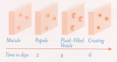 My Sanctuary: Four days into having Chicken Pox...