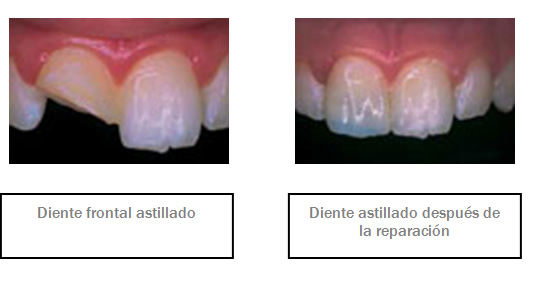 Dental Perfect: ¿Dientes dañados?