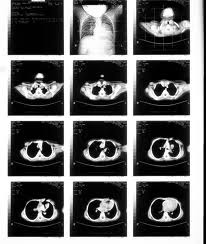 AKHSANUR BLOG'S: Hasil CT Scan Thorax, Abdomen, Whole Spine