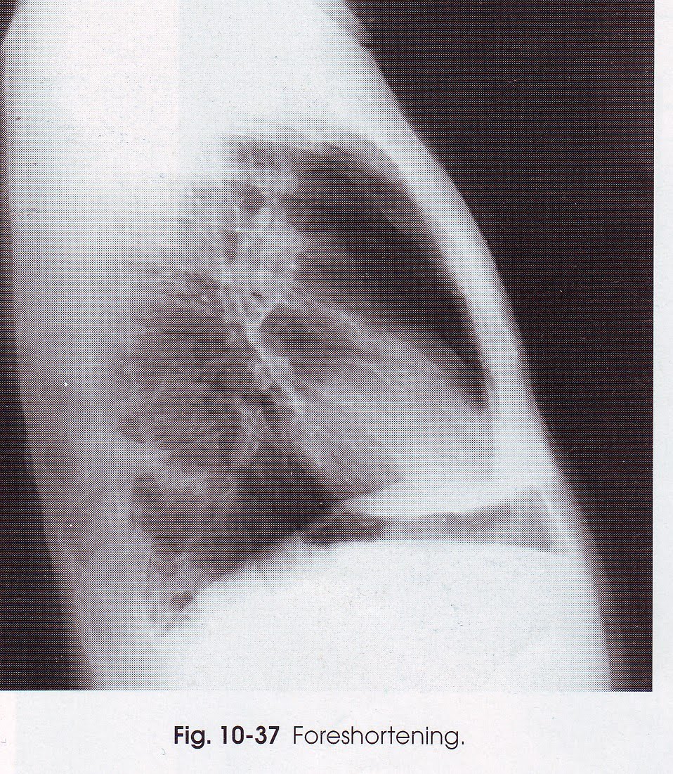 AKHSANUR BLOG'S: TEKNIK RADIOGRAFI THORAX