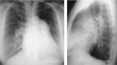 AKHSANUR BLOG'S: Cardiothoracic Ratio (CTR)