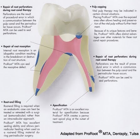 Dental materials: Mineral trioxide aggregate (MTA) in endodontics