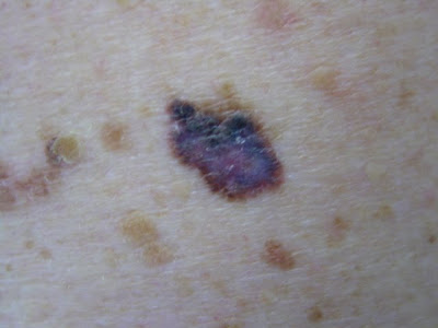 Skin Cancer College of ANZ Journal Updates: Melanoma Excision Margins