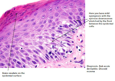 Teaching Dermatopathology: 10. Epidermal Patterns- Spongiotic