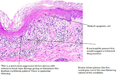 Teaching Dermatopathology: 12. Dermal Lichenoid pattern