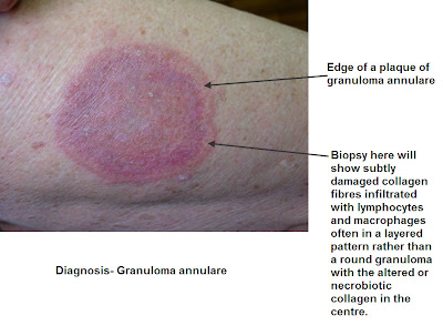 Teaching Dermatopathology: 14. Dermal Granulomatous pattern