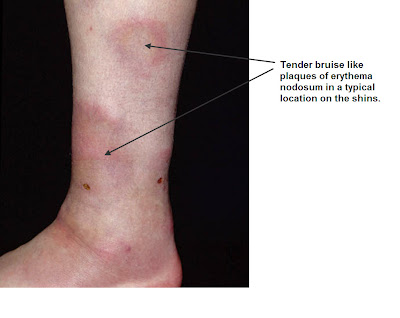 Teaching Dermatopathology: 17. Dermal Panniculitis pattern