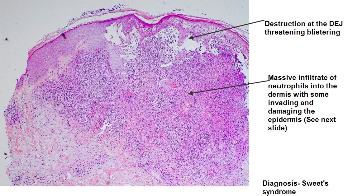 Teaching Dermatopathology: 16. Dermal infiltrates of cells or substances