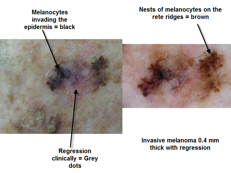Dermoscopy Made Simple: Colours in Dermoscopy
