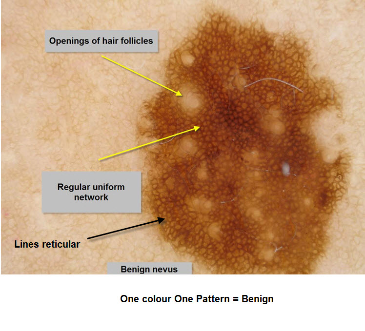 Dermoscopy Made Simple: Lines