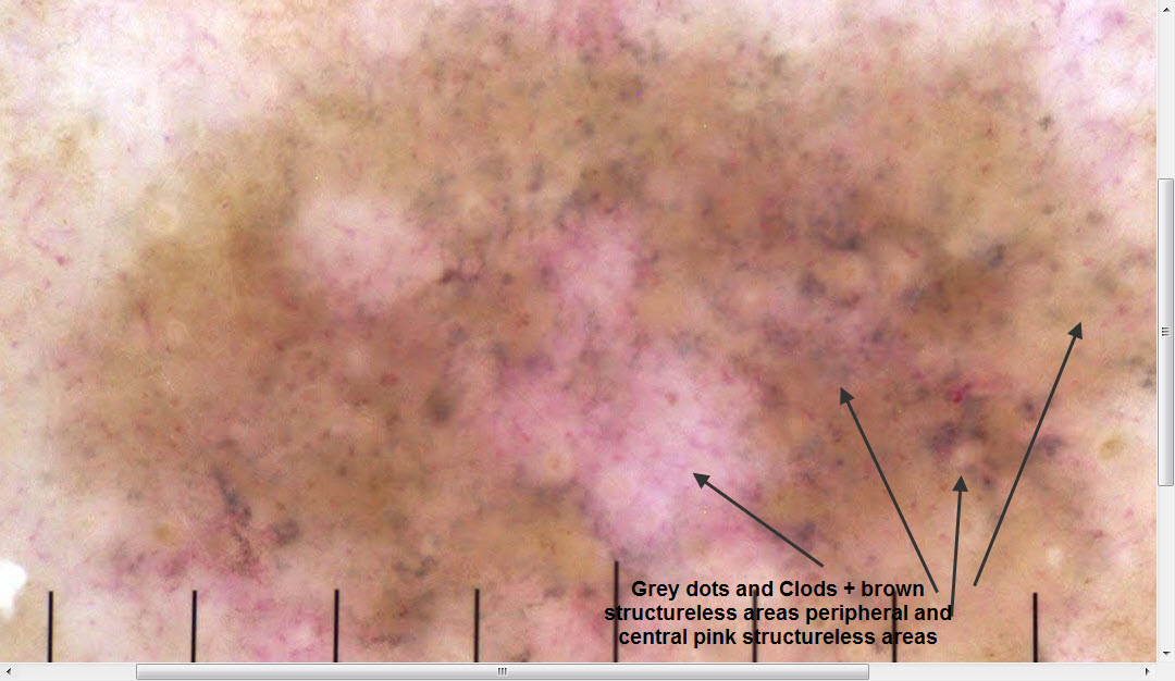 Dermatoscopy Made Simple: Great Blog Cases