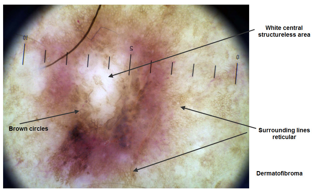 Dermoscopy Made Simple: Great Blog Cases