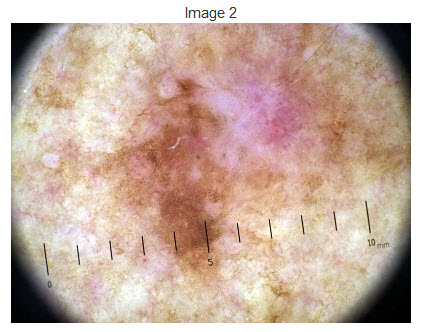 Dermoscopy Made Simple: Great Blog Cases