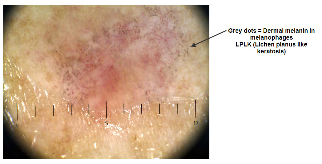 Dermoscopy Made Simple: Great Blog Cases